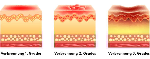 Was tun bei Brandwunden?